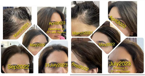 Compare the Efficacy of PRP Intervention VS Exosomes for Hair loss, a Case Series Study